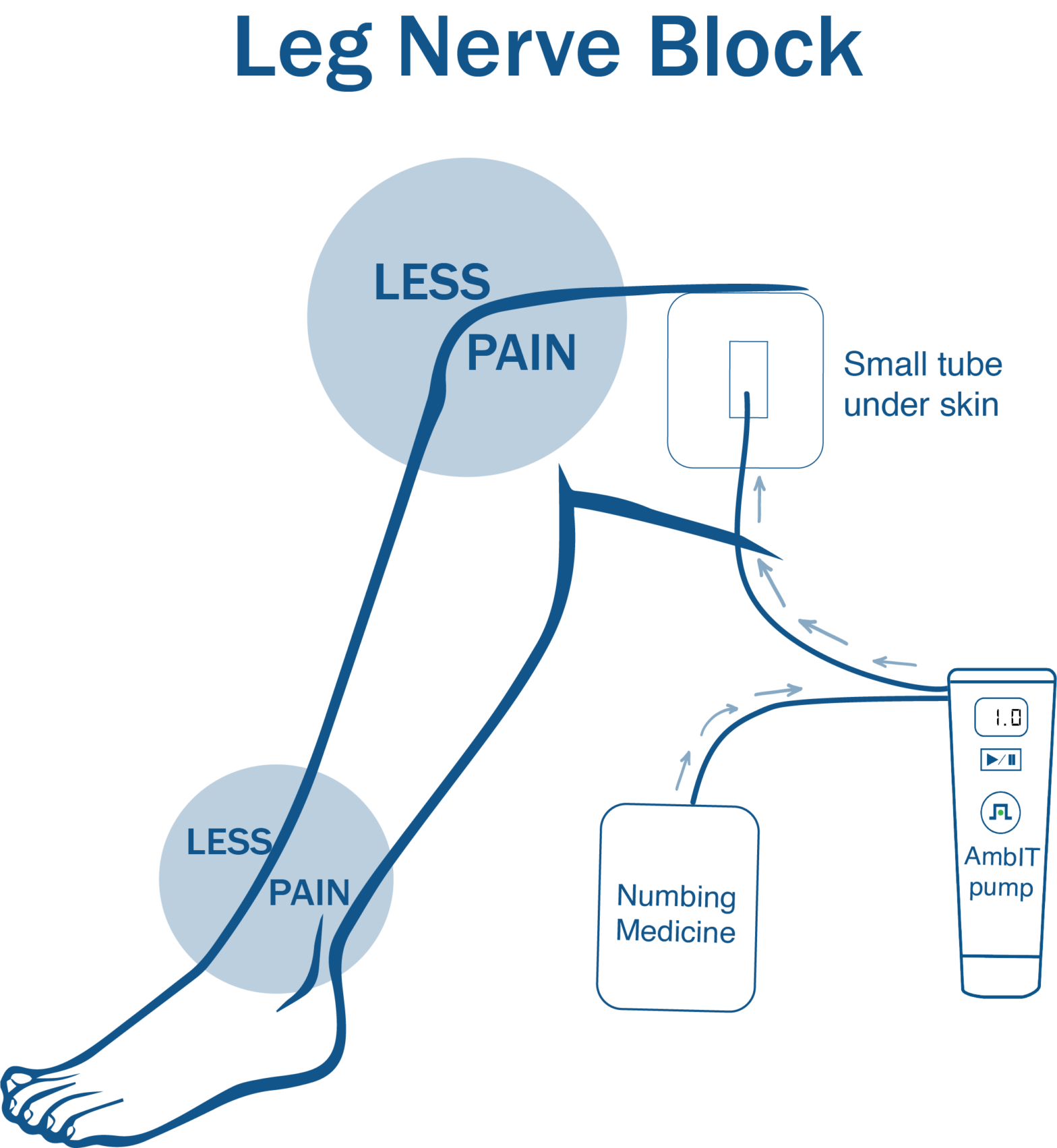Managing surgical pain with a nerve block – USAP – Anesthesia Pain ...